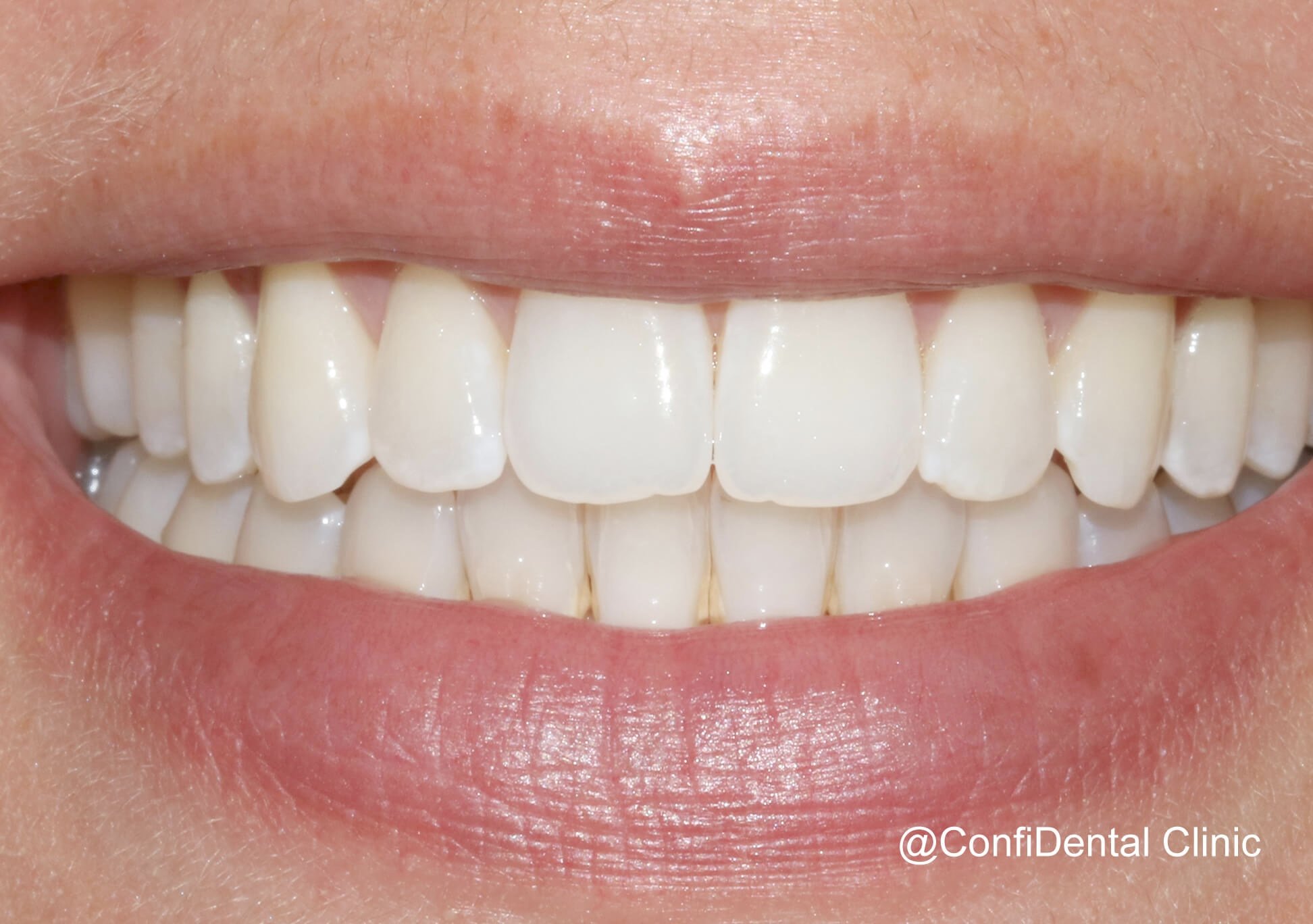 Teeth Straightening in Sutton | Invisalign & Braces | ConfiDental ...